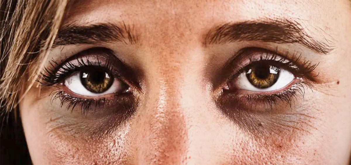 Here's How to Remove or Reduce Your Dark Under Eye Circles – Beauty Of ...