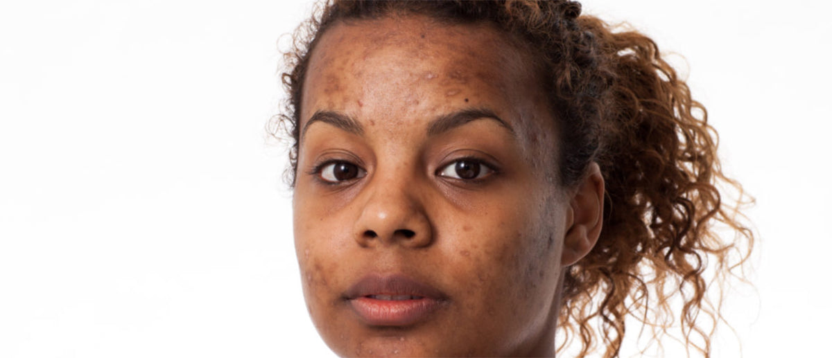 Say Goodbye to Acne Scars on Skin-of-Color with These 16 Effective Tre ...
