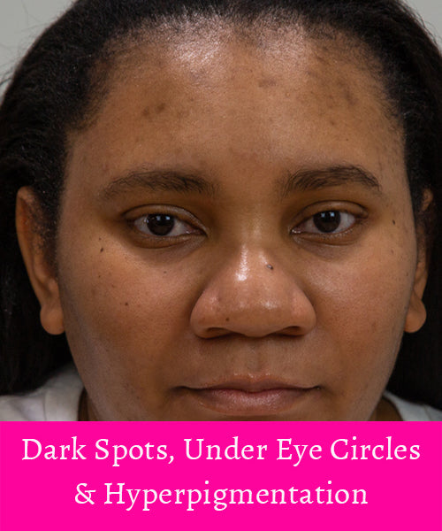 Hyperpigmentation – Beauty Of The Nile